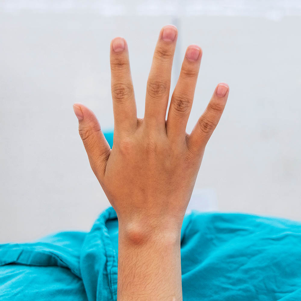 Talgcyste - Chirurgisch Centrum